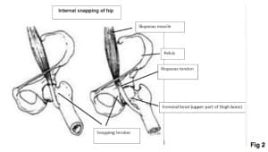 What is Snapping Hip Syndrome? | NY Bone & Joint